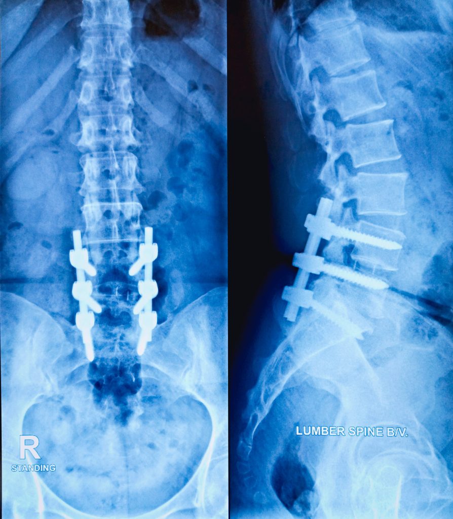 A Guide to Sacroiliac Joint Stem Cell Treatment: Understanding Your Options